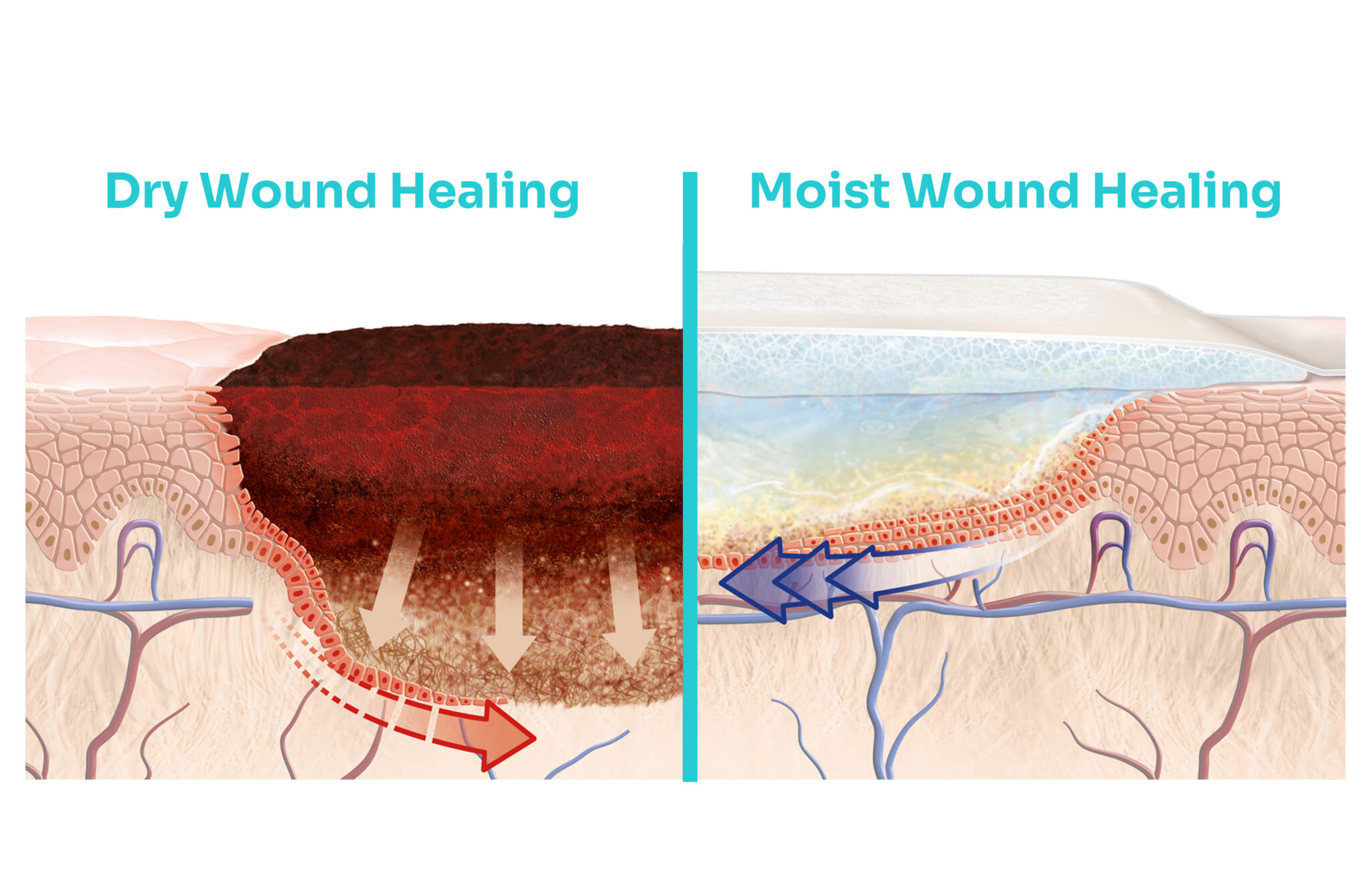 Moist Wound Healing vs. Dry Wound Healing - Conkote- Medical supply experts