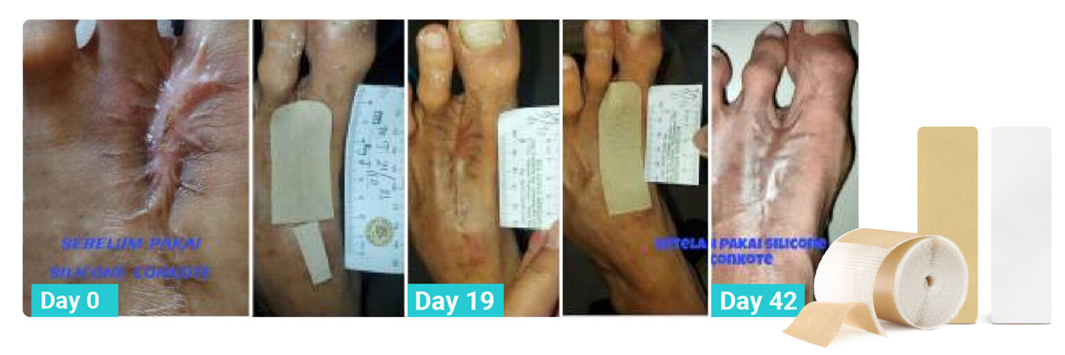 How Silicone Scar Sheets Work – Improve Scar Healing