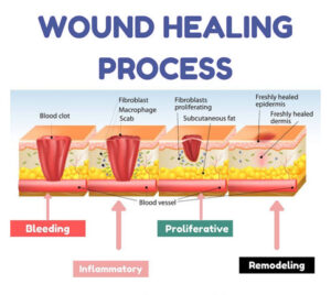 The 4 Stages of Wound Healing Explained | A Complete Guide
