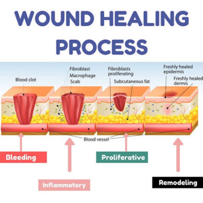 The 4 Stages of Wound Healing Explained | A Complete Guide